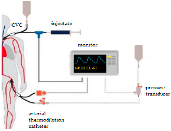 PiCCO or Cardiac Ultrasound? Which Is Better for Hemodynamic Monitoring ...