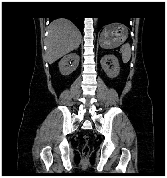Optimizing Scan Range in Computed Tomography of Kidneys, Ureters, and Bladder: A Retrospective ...