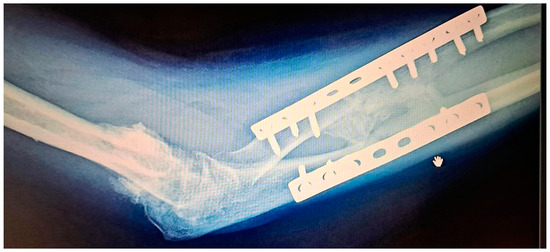Surgical Treatment of Post-Traumatic Radio-Ulnar Synostosis