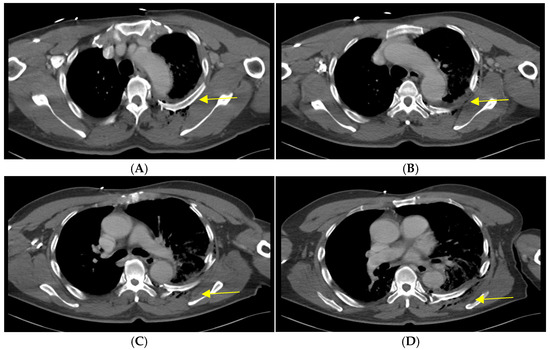 Comminuted Paraspinal Rib Fractures with Resultant Impending ...
