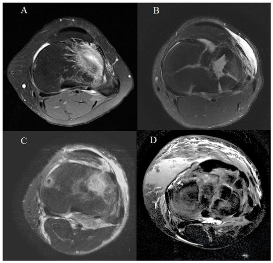 Evaluating Meniscus, Ligament and Soft Tissue Injury Using MRI in ...