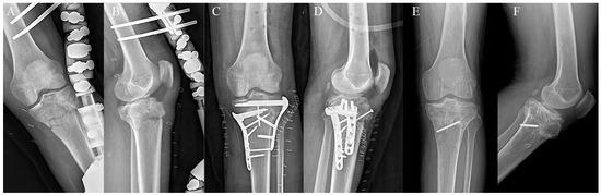 Evaluating Meniscus, Ligament and Soft Tissue Injury Using MRI in ...