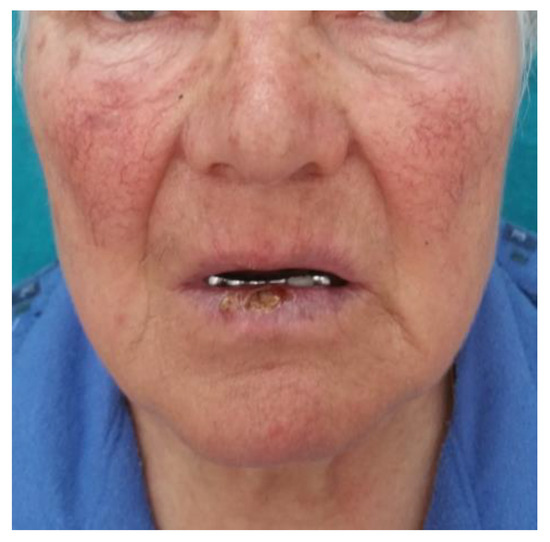 Original Personalized Reconstruction Method for Certain Large Tumors of ...