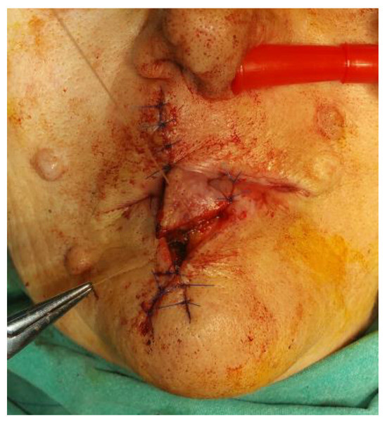 Original Personalized Reconstruction Method for Certain Large Tumors of ...