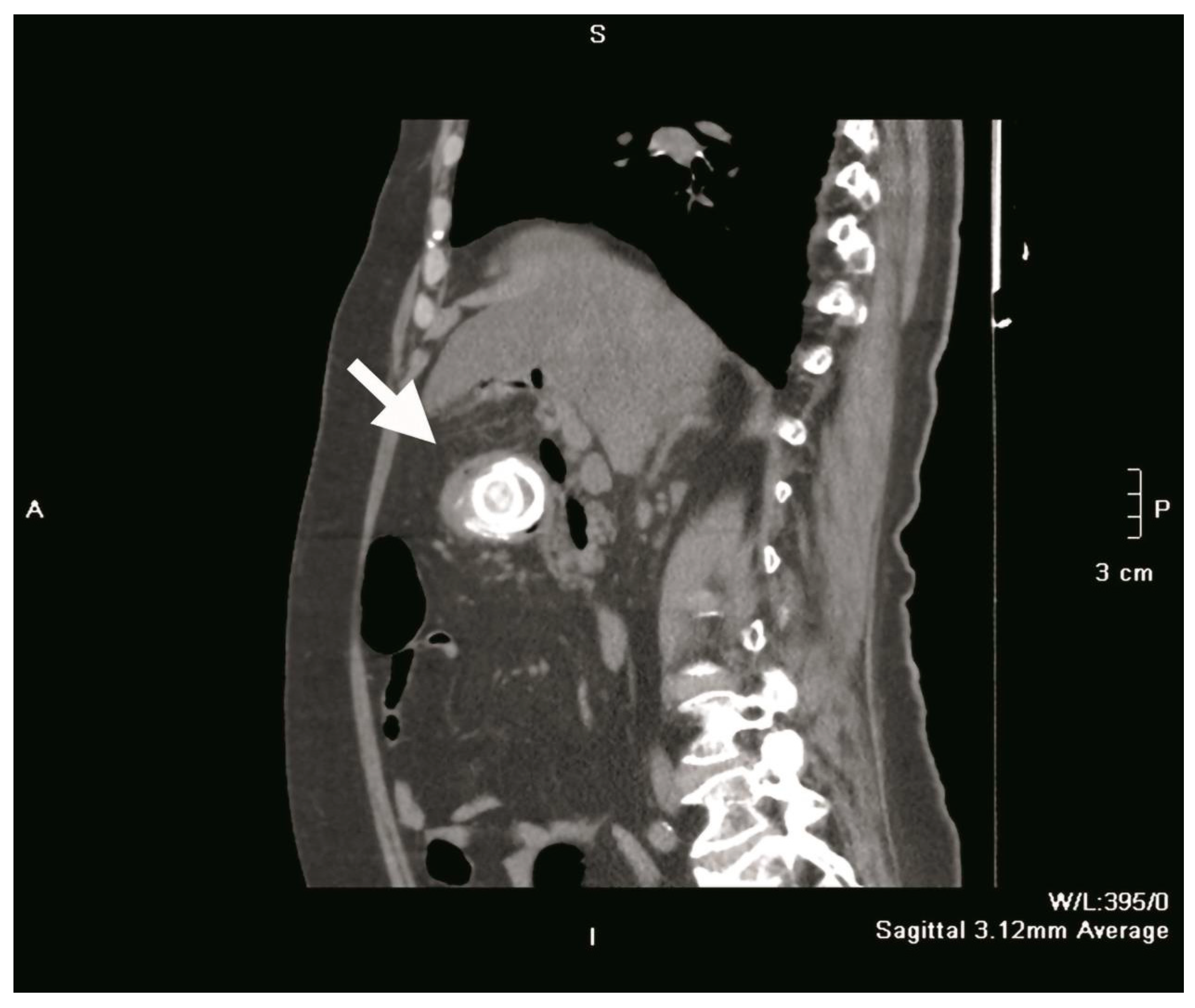 Bouveret’s Syndrome as a Rare Life-Threatening Complication of ...