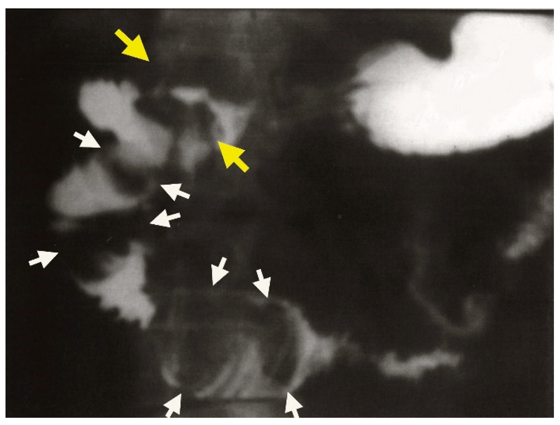 Bouveret’s Syndrome as a Rare Life-Threatening Complication of ...