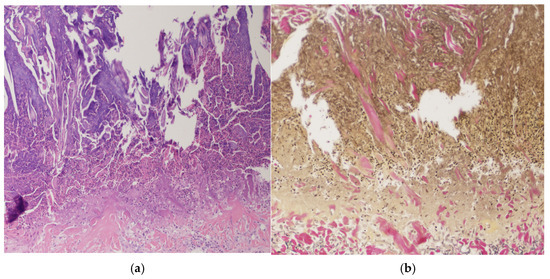 A Case of Acquired Reactive Perforating Dermatosis with Complete ...