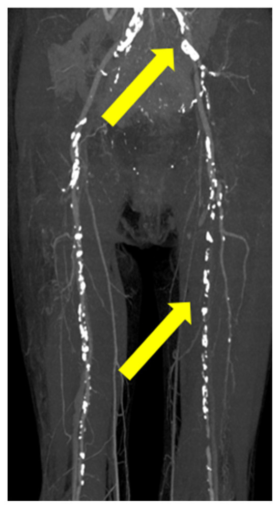 A Case of Acquired Reactive Perforating Dermatosis with Complete ...