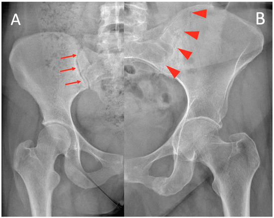 Evaluation of Sacroiliac Joint Shape in Women with Ankylosing ...