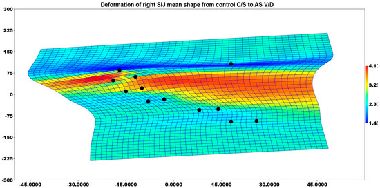 Evaluation of Sacroiliac Joint Shape in Women with Ankylosing ...