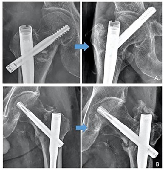 High Fixation Failure Rate of Cephalomedullary Nail Fixation in ...