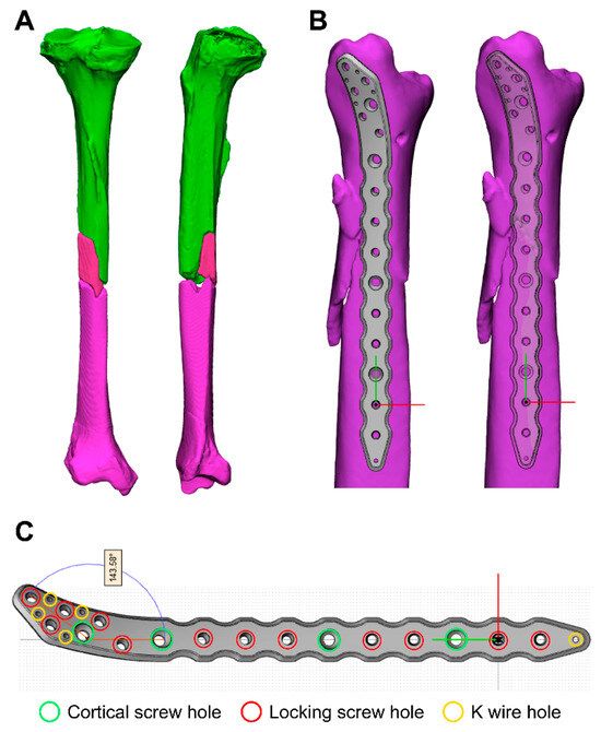 Clinical Efficacy of Three-Dimensional-Printed Pure Titanium Fracture ...