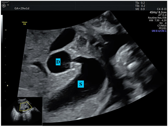 Clinical Analysis of Congenital Duodenal Obstruction and the Role of ...
