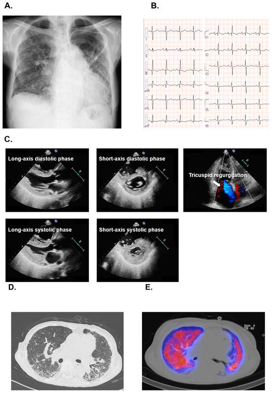 Efficacy of Inhaled Treprostinil in a Patient with Systemic Sclerosis ...