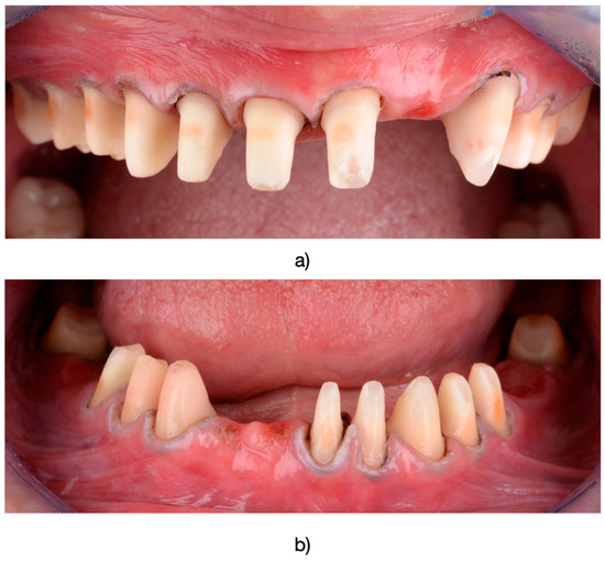 Retrospective Long-Term Survival Rate and Clinical Performance of Zirconium Oxide Restorations ...