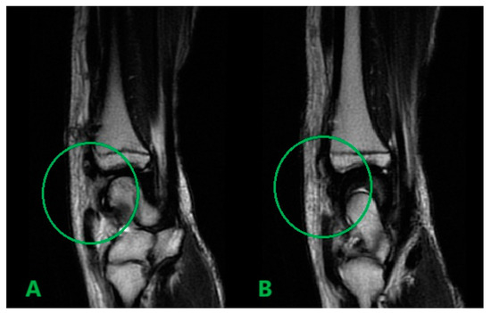 Neglected Zone VII Extensor Tendons Reconstruction with a Palmaris ...