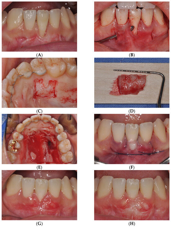 Comparative Study of Two Root Coverage Procedures for Localized ...