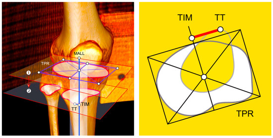 Tibial Tuberosity–Tibial Intercondylar Midpoint Distance Can Be ...