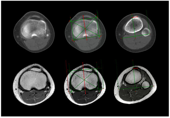 Tibial Tuberosity–Tibial Intercondylar Midpoint Distance Can Be ...