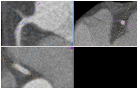 Evaluation of Coronary Artery Luminal Diameters in Patients with ...