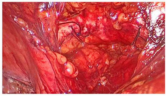 The Efficacy of Modified Laparoscopic Burch Procedure Using a Single ...
