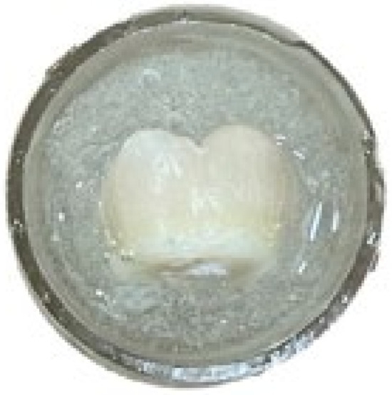 The Efficacy of Remineralizing Materials on Artificial Enamel Lesions ...