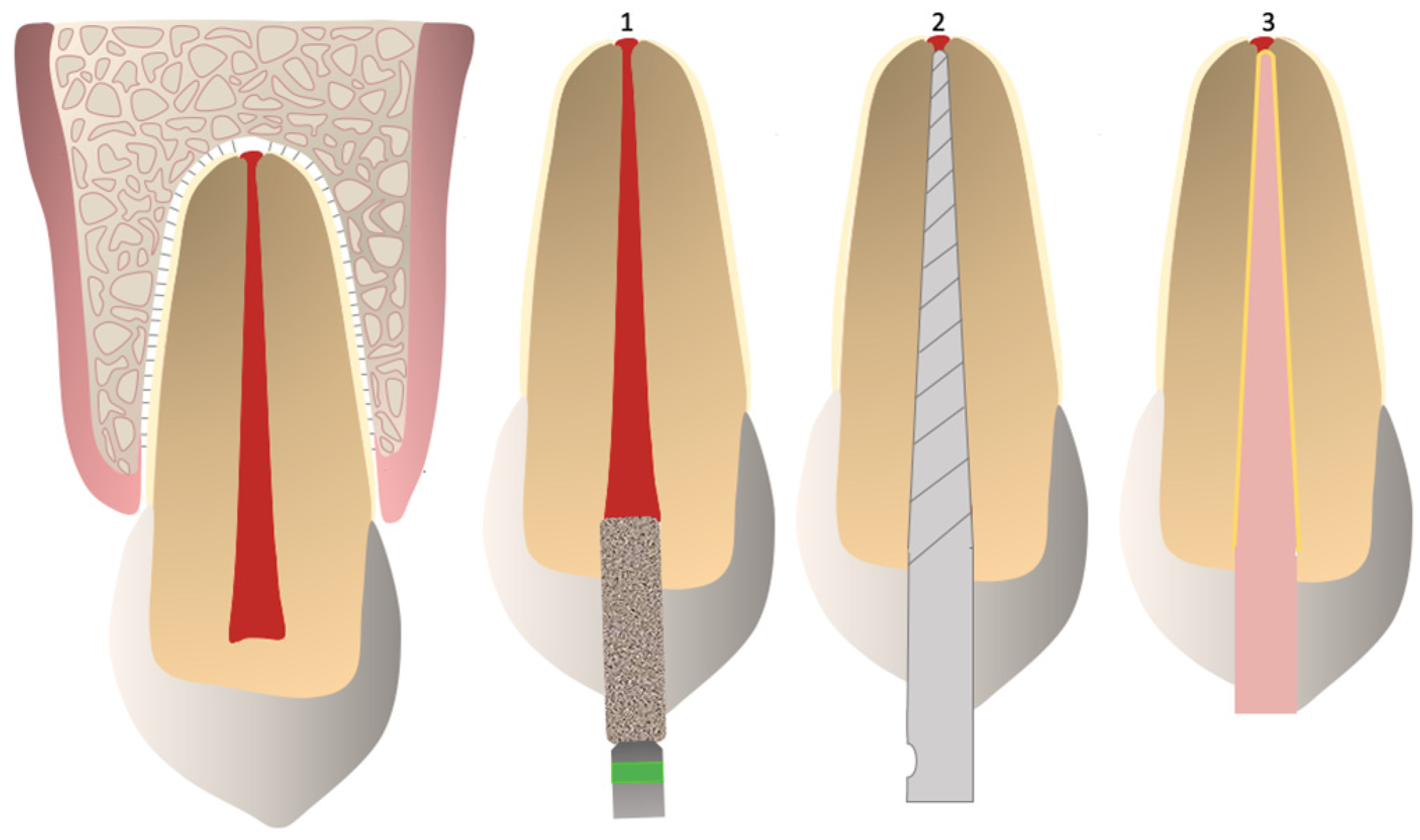 Quality of Single-Cone Obturation Using Different Sizes of Matching Gutta-Percha Points of Two ...