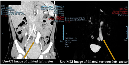 Endoscopic Balloon Dilation for Primary Obstructive Megaureter in ...