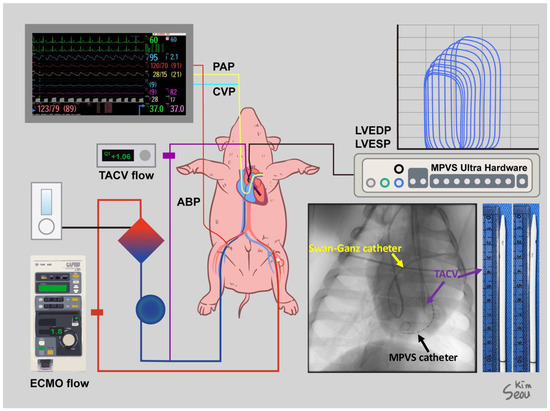 Transaortic Catheter Venting for Left Ventricular Unloading in Veno ...