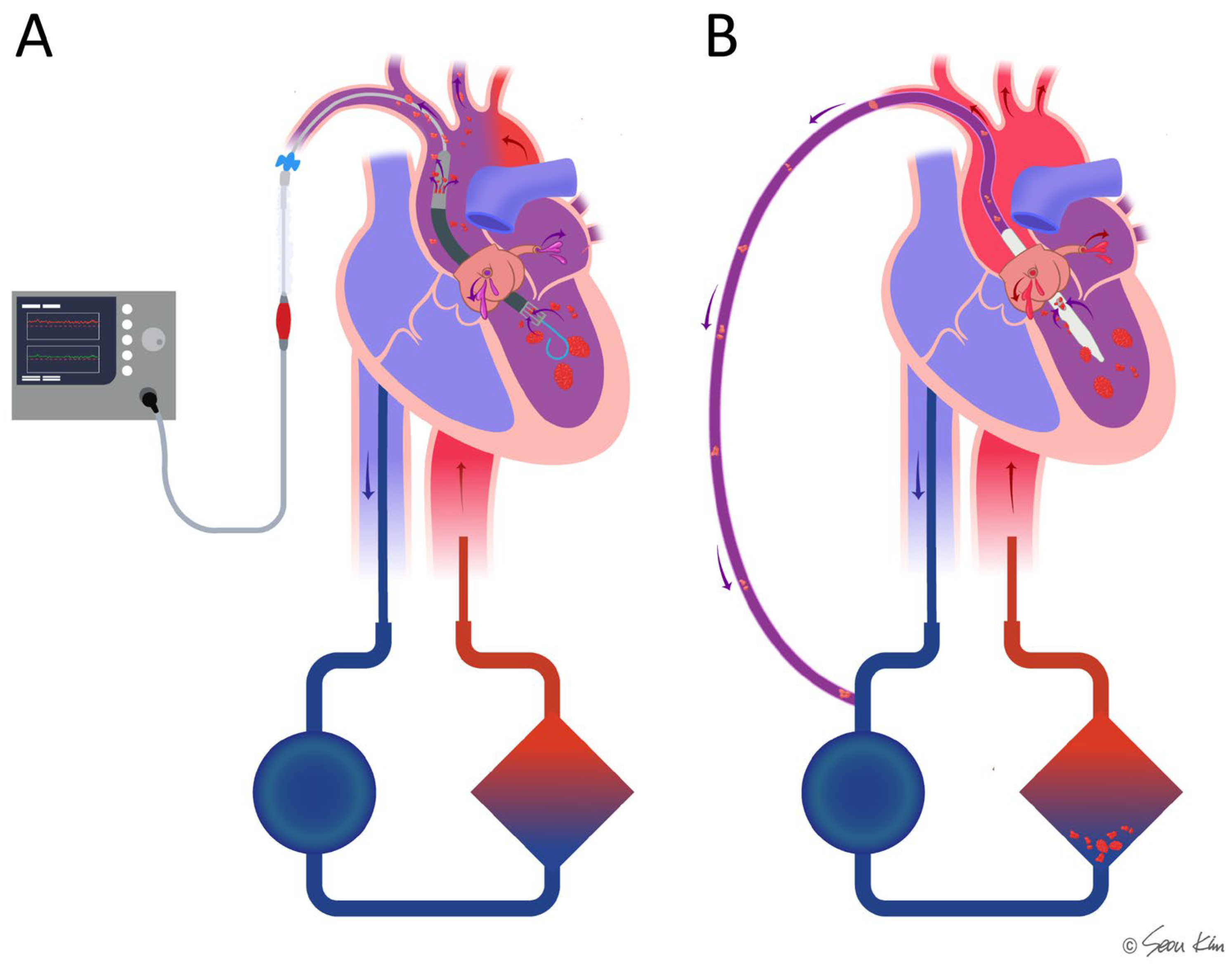 Transaortic Catheter Venting for Left Ventricular Unloading in Veno ...