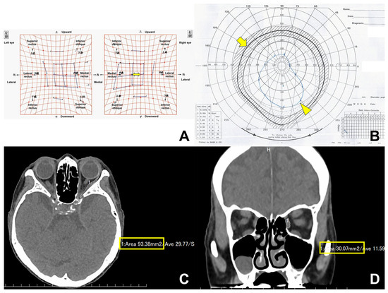 Lateral Rectus Muscle Resection for New-Onset Esotropia Following ...