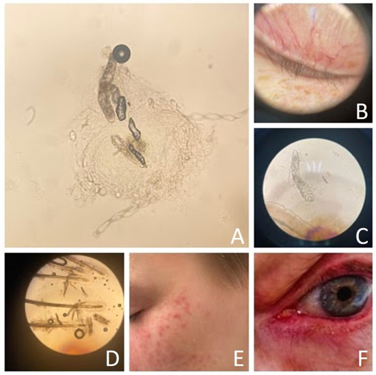 Eyelash Mite Infestation