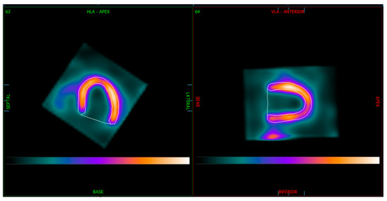 Comparative Analysis of Cardiac SPECT Myocardial Perfusion Imaging ...