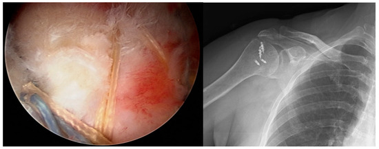 A Comparison of the Results of Two Different Double-Row Repair ...