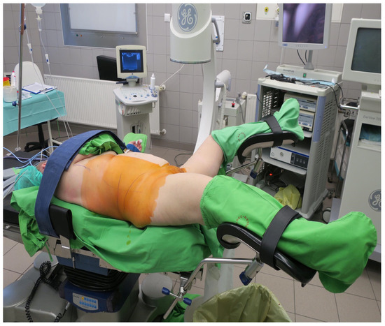 Tubeless Percutaneous Nephrolithotomy in the Barts ‘Flank-Free ...