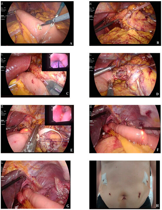 A Novel and Feasible Intracorporeal Esophagojejunostomy Anastomosis in ...