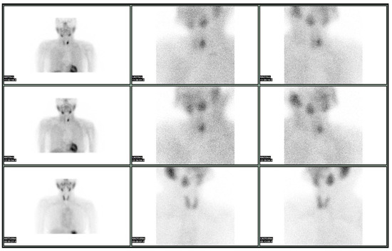 A Narrative Review of the Odyssey of Thyroid Cancer Diagnosis: Can ...