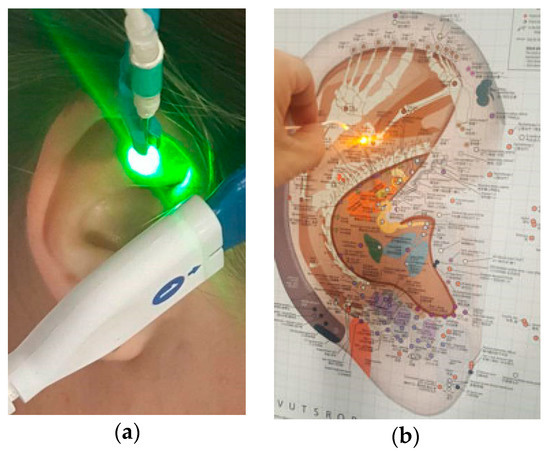 Gender Differences in Laser Acupuncture—Results of a Crossover Study ...