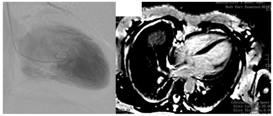 Takotsubo as Initial Manifestation of Non-Myopathic Cardiomyopathy Due ...
