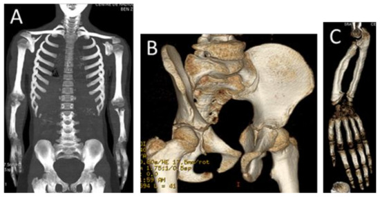 Leri-Weill Dyschondrosteosis Syndrome: Analysis via 3DCT Scan