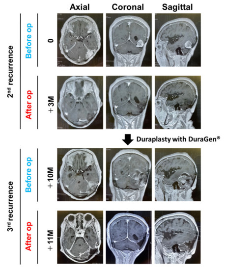 Meningioma Cell Invasion into DuraGen-Derived Dura Mater: A Case Report