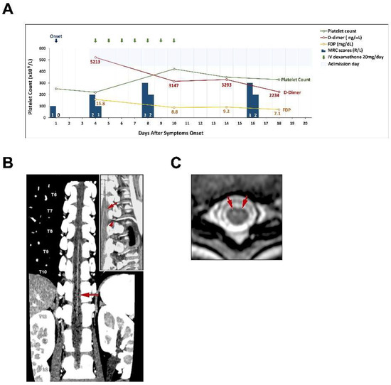 Medicines | Free Full-Text | Postpartum Spinal Cord Infarction: A Case ...