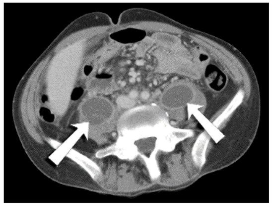 Disseminated MAI in an HIV Patient-An Unusual Presentation