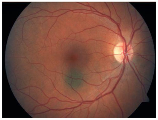 Choroidal Melanoma: A Mini Review