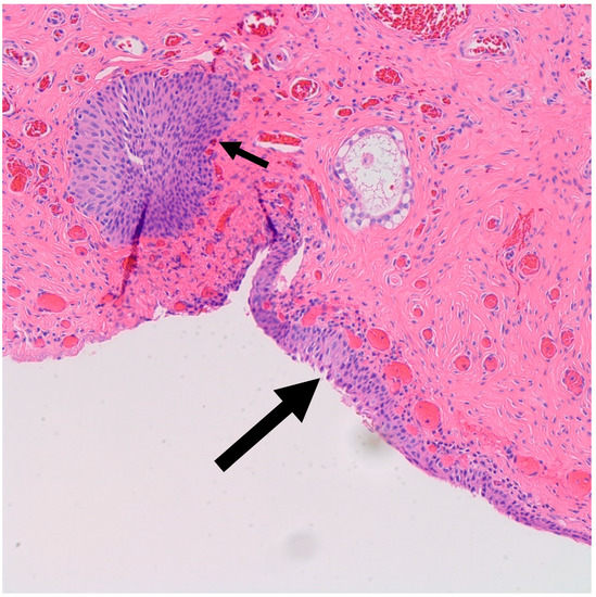 Brenner Tumor of the Ovary: A 10-Year Single Institution Experience and ...