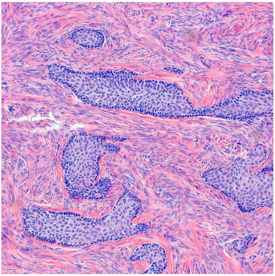 Brenner Tumor of the Ovary: A 10-Year Single Institution Experience and ...