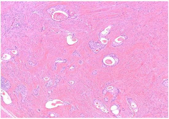 Brenner Tumor of the Ovary: A 10-Year Single Institution Experience and ...