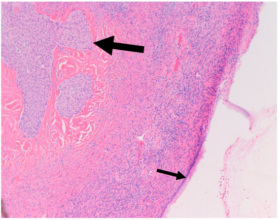 Brenner Tumor of the Ovary: A 10-Year Single Institution Experience and ...