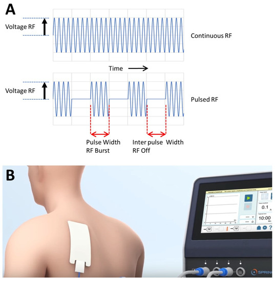 The Anti-Inflammatory Action of Pulsed Radiofrequency—A Hypothesis and ...