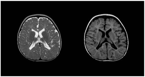Leukodystrophy Imaging: Insights for Diagnostic Dilemmas